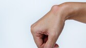 Schnappfinger: Orthopäde erklärt Ursachen und Behandlung - FITBOOK