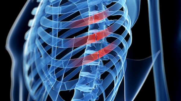 Rippenbruch: Symptome, Therapie, Dauer der Heilung - FITBOOK