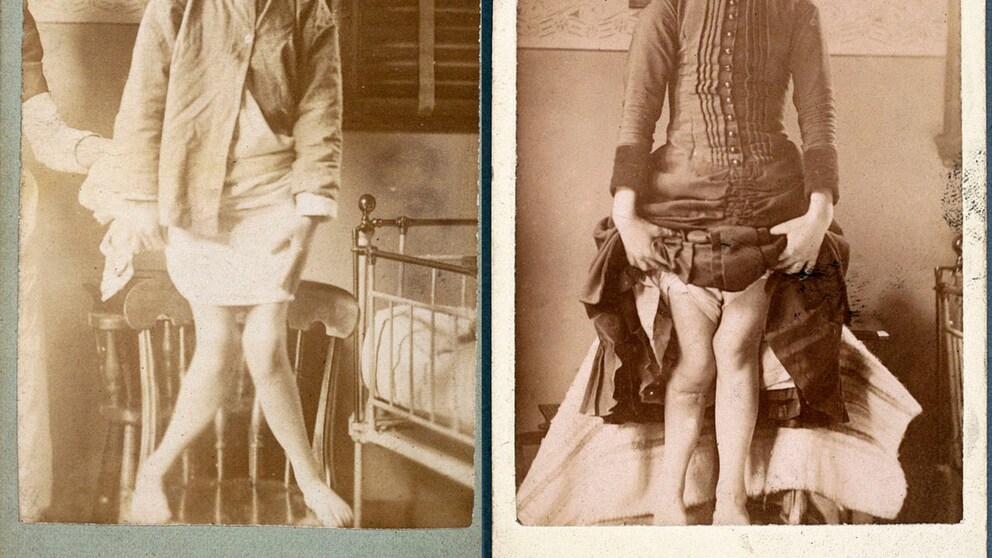 Rachitis – Krankheit aus dem 19. Jahrhundert kehrt zurück - FITBOOK