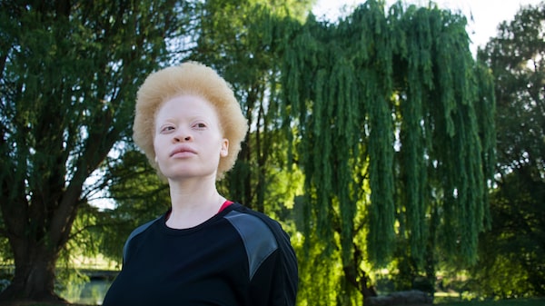 Albinismus: Ursachen und Symptome der seltenen Erkrankung - FITBOOK