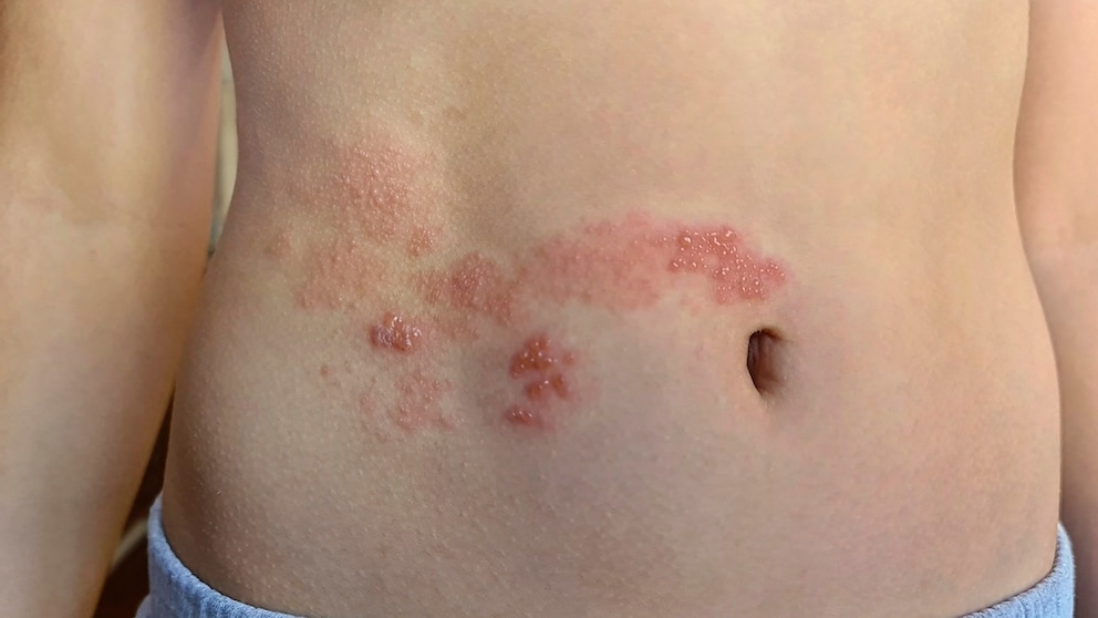 Gürtelrose: Symptome, Ursachen, Behandlung von Herpes Zoster