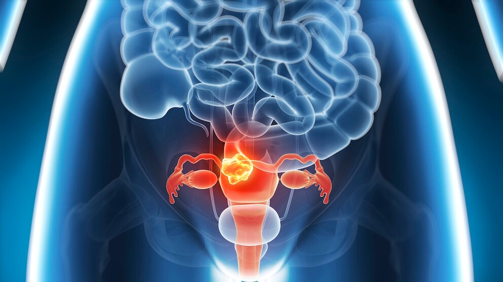 Adenomyose: Ursache, Symptome, Behandlung - FITBOOK