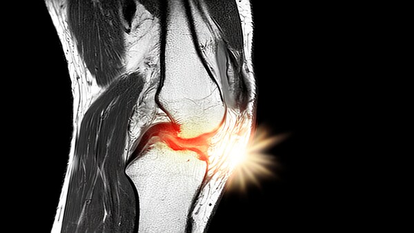 Meniskusriss: Ursachen, Symptome, Behandlung- FITBOOK